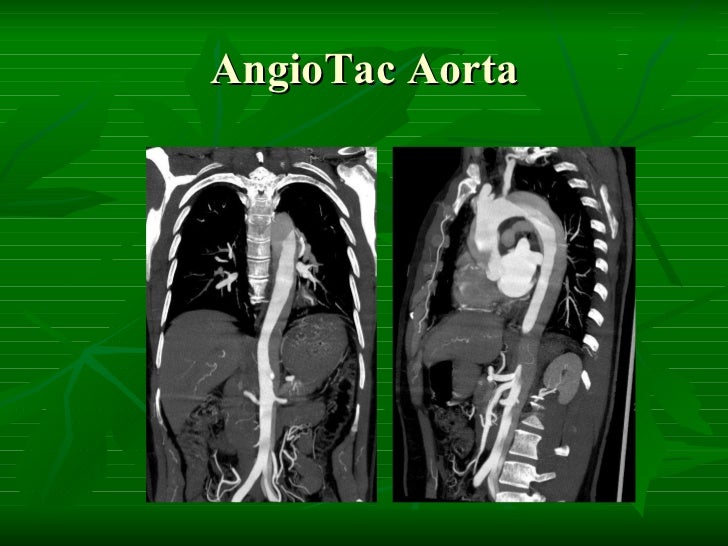 Tc angio tac