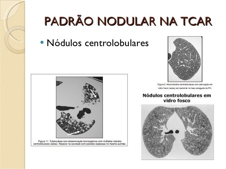 TC de alta resolução do Pulmão
