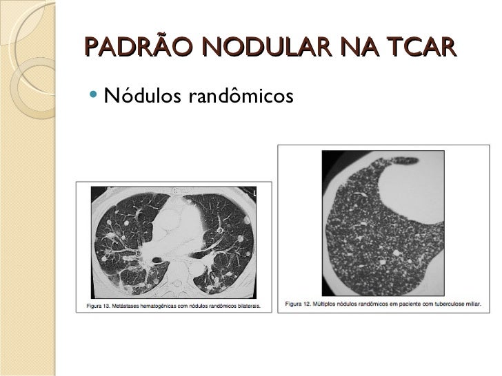 TC de alta resolução do Pulmão