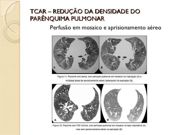 TC de alta resolução do Pulmão