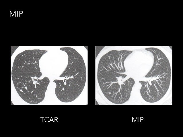 Tac Torax Patron Nodular