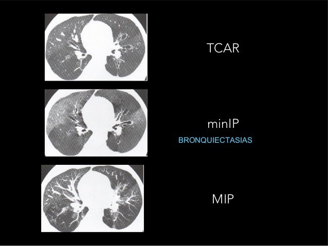 Tac Torax Patron Nodular Casos PEDiatricos On Line [Web PEDiatrica]