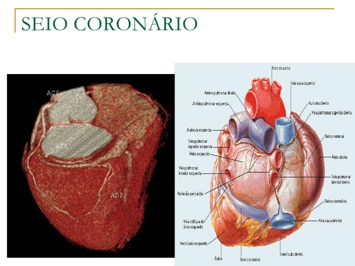 Tomografia Computadorizada de Artérias Coronarias