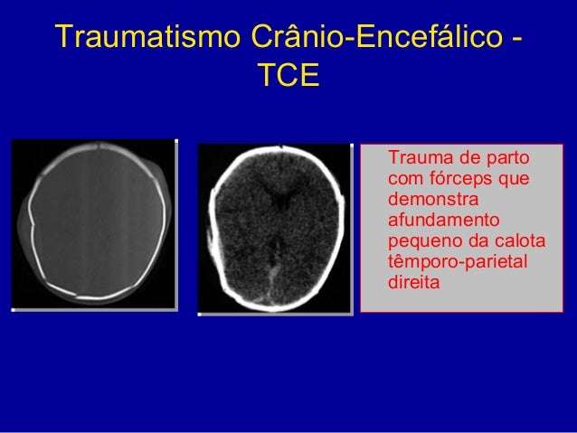 Tce