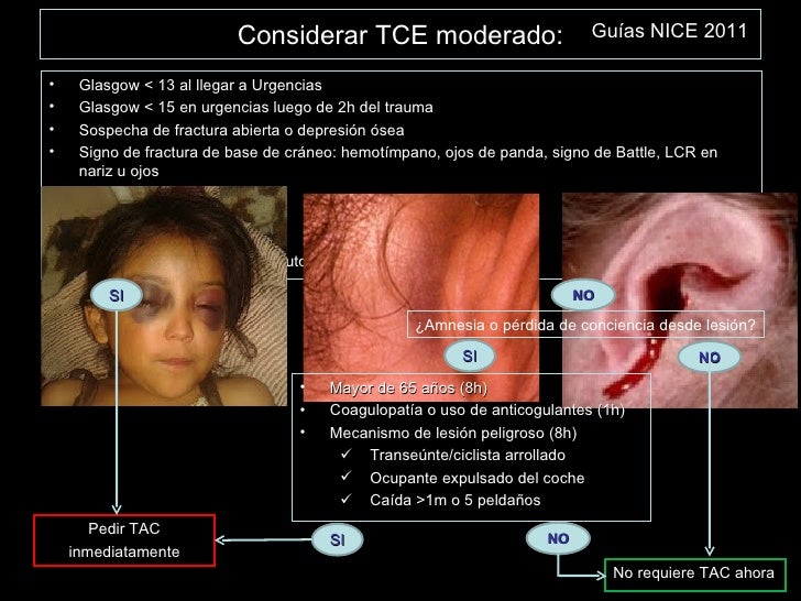 Traumatismo Craneoencefálico leve