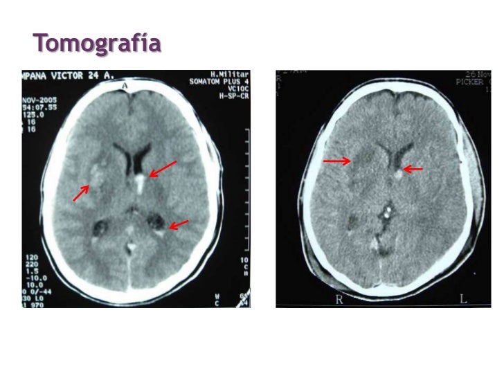 Trauma Craneo Encefalico TCE