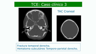 Manejo del TCE en pediatría (por Mª Teresa Fernández Castaño) | PPTX
