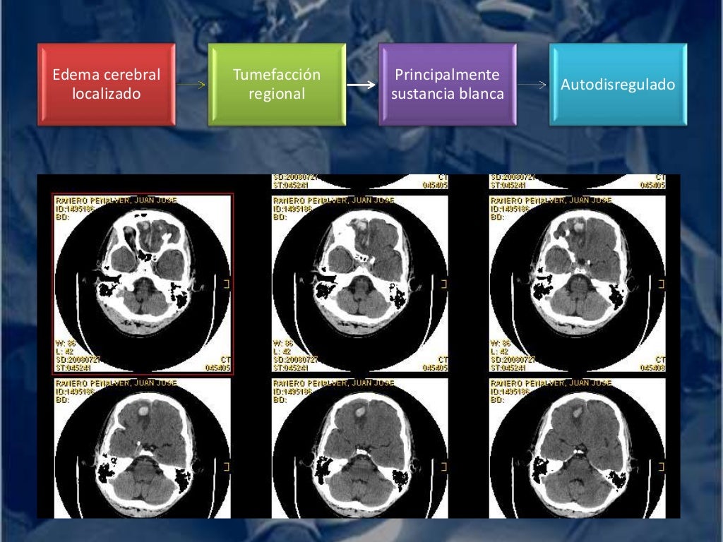 TCE. Traumatismo craneoencefálico, diagnóstico y tratamiento.