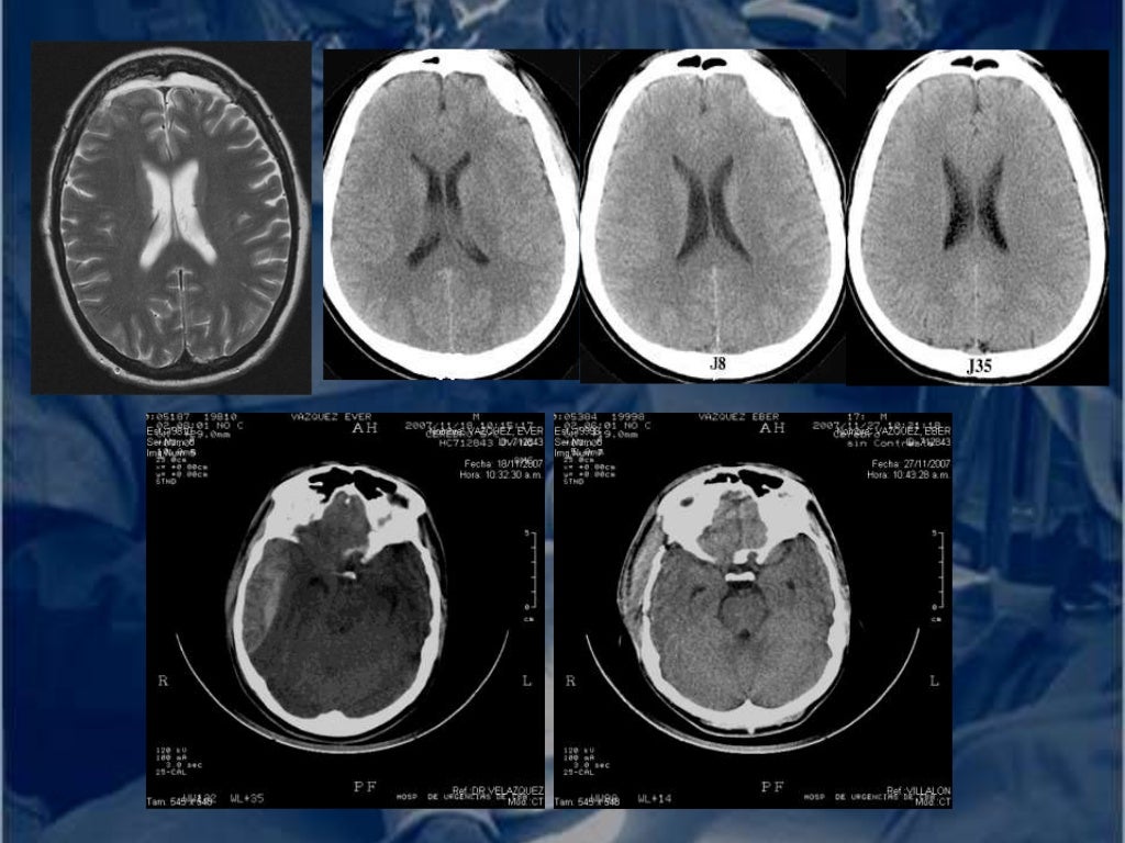 TCE. Traumatismo craneoencefálico, diagnóstico y tratamiento.