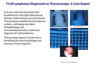 Thoracoscopy as an aide to diagnose T Cell Lymphoma | PPTX