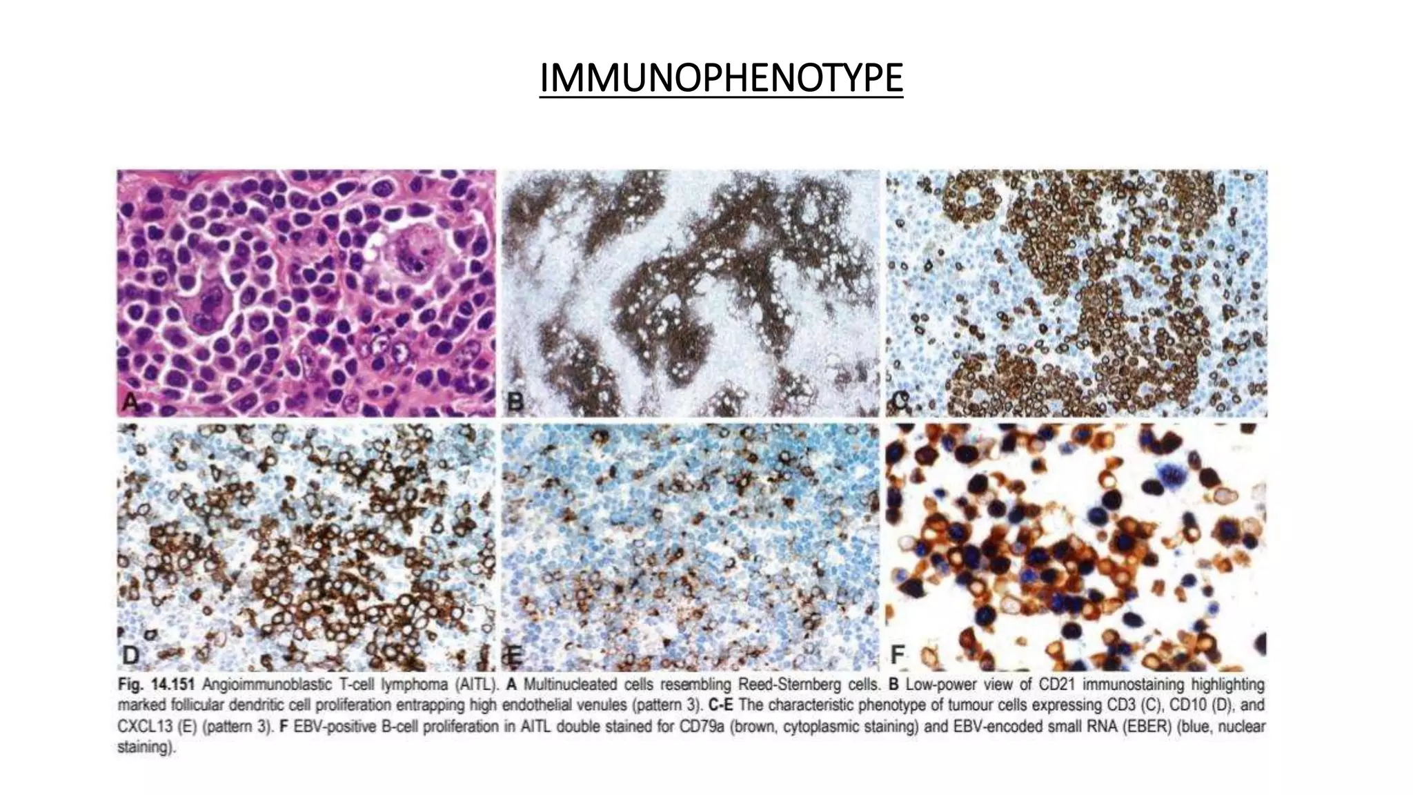 T cell lymphomas - By Dr MULUKALA SWETHA | PPTX