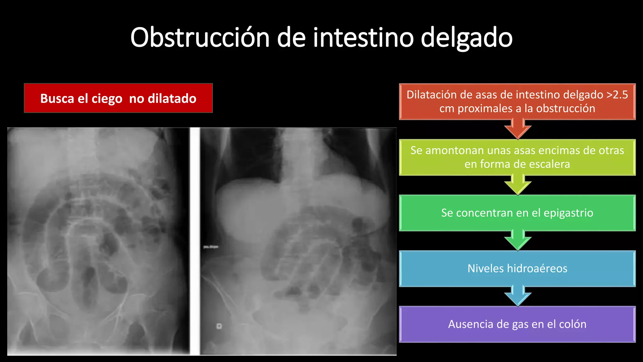 TC en obstrucción intestinal-1.pptx