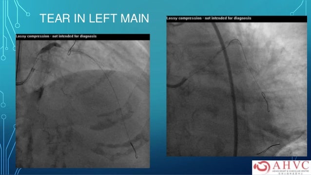 Is Bypass Operation Still The Only Option For Left Main Disease And C…