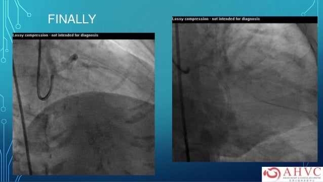 Is Bypass Operation Still The Only Option For Left Main Disease And C…