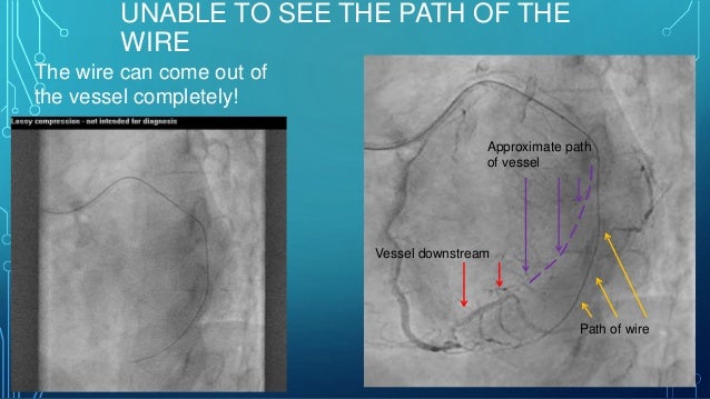 Is Bypass Operation Still The Only Option For Left Main Disease And C…