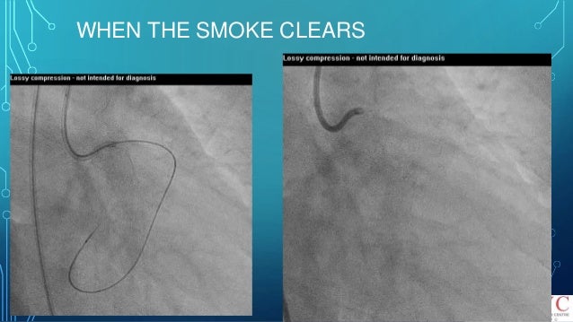 Is Bypass Operation Still The Only Option For Left Main Disease And C…