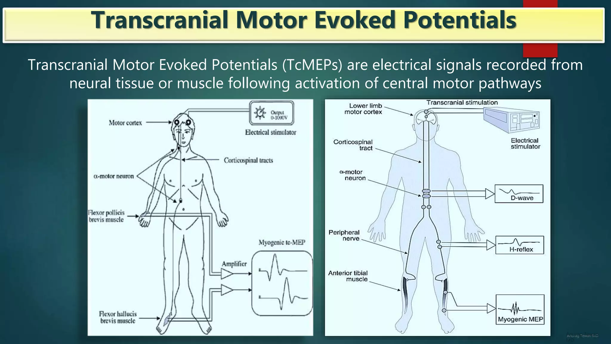Transcranial Motor Evoked Potentials Monitoring per aACNS guidelines | PPTX