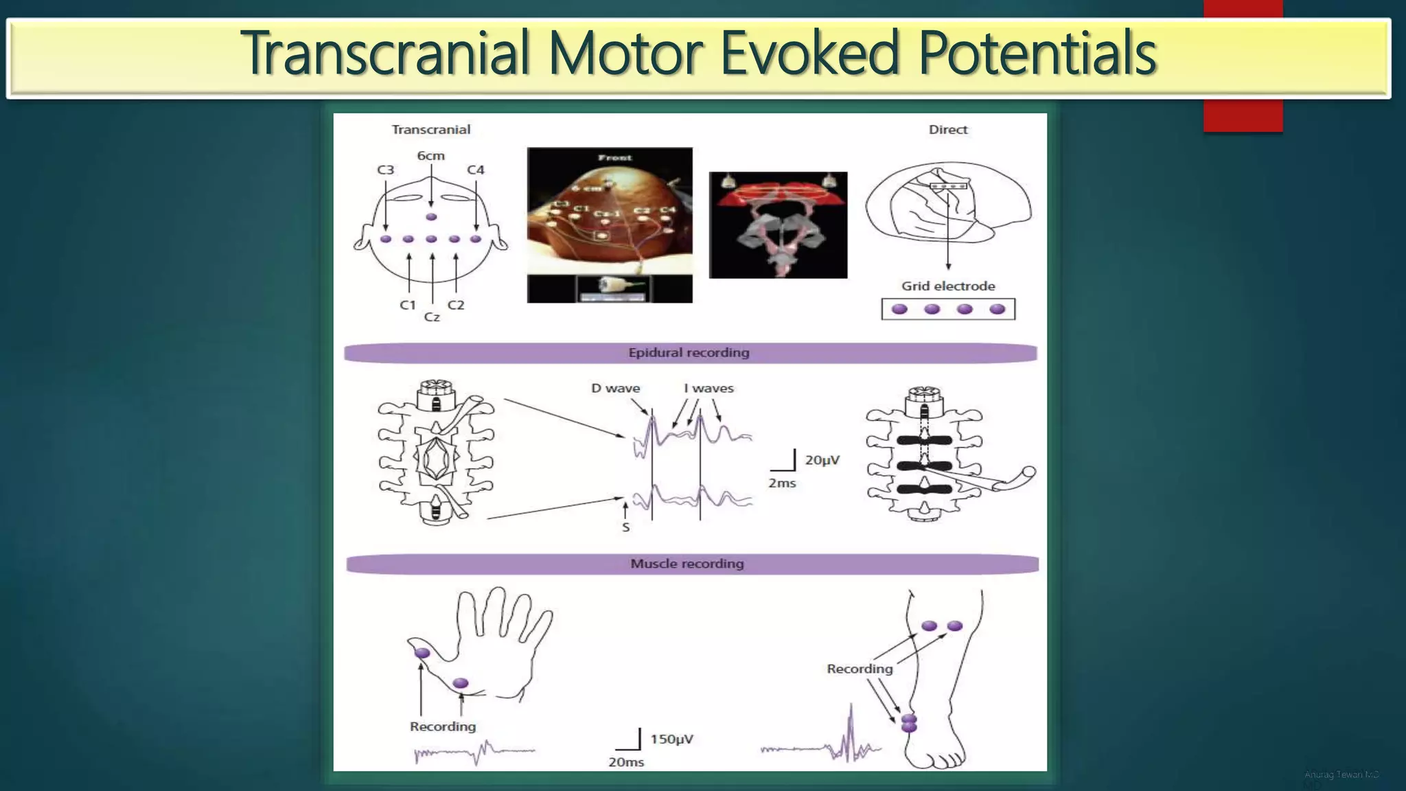 Transcranial Motor Evoked Potentials Monitoring per aACNS guidelines | PPTX