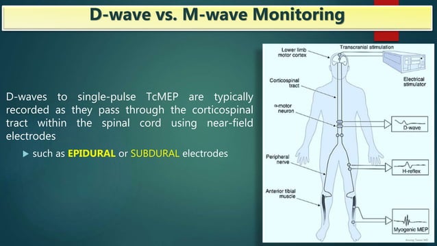 Transcranial Motor Evoked Potentials Monitoring per aACNS guidelines | PPTX