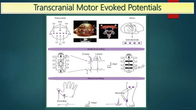 Transcranial Motor Evoked Potentials Monitoring per aACNS guidelines | PPTX