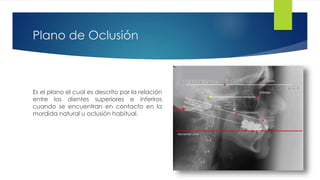 Tecnica de Articulado: Hanau 194, Stratos 300, Whipmix (Manuales) | PPTX