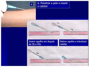 técnica de AVP.pptx
