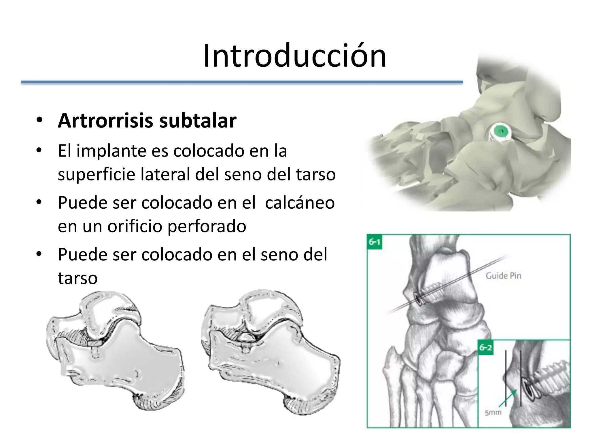 Técnica de calcaneo stop vs endortesis en el pie plano infantil | PPT