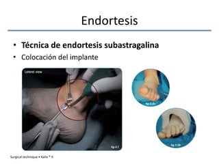 Técnica de calcaneo stop vs endortesis en el pie plano infantil