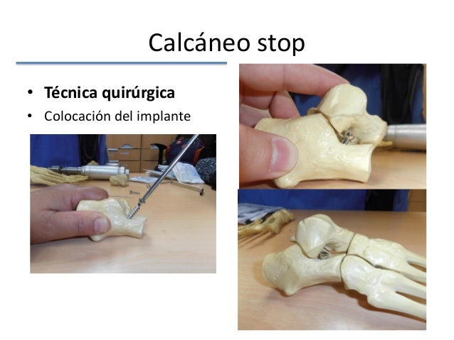 Técnica de calcaneo stop vs endortesis en el pie plano infantil