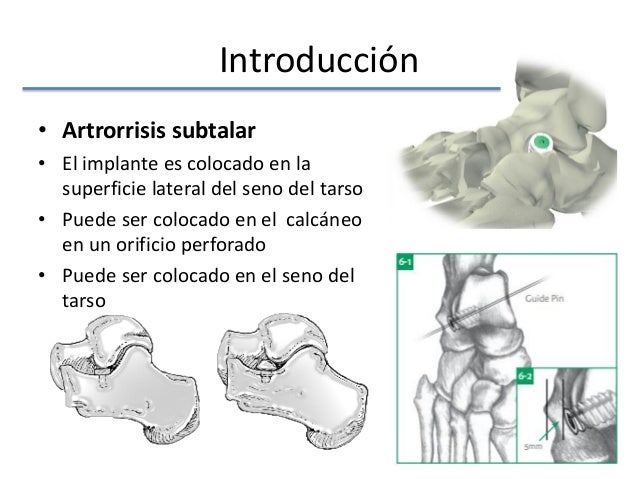 Técnica de calcaneo stop vs endortesis en el pie plano infantil