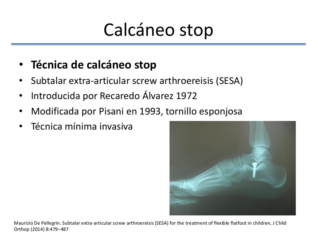 Técnica de calcaneo stop vs endortesis en el pie plano infantil