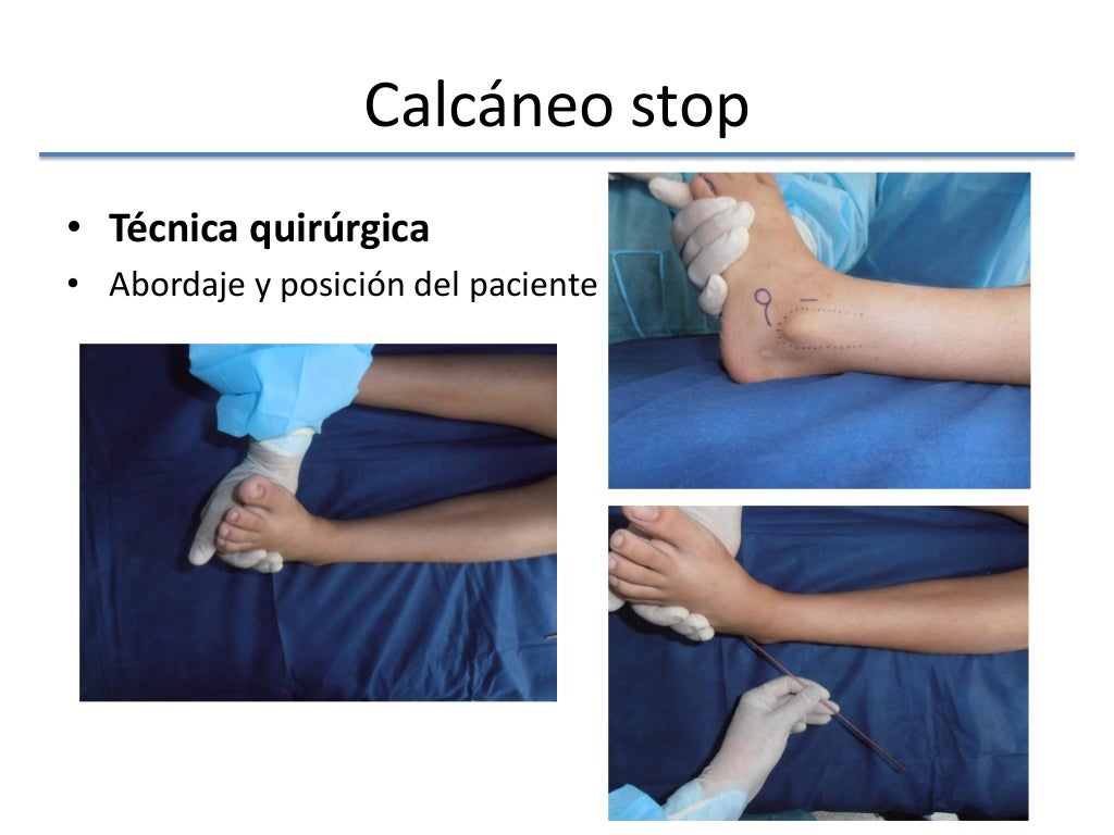 Técnica de calcaneo stop vs endortesis en el pie plano infantil