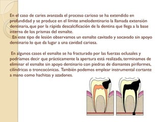 Técnica de restauración de clase i oclusal | PPTX