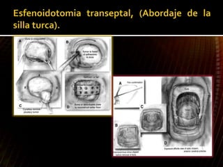 Técnica quirúrgica del seno esfenoidal y valvular | PPTX
