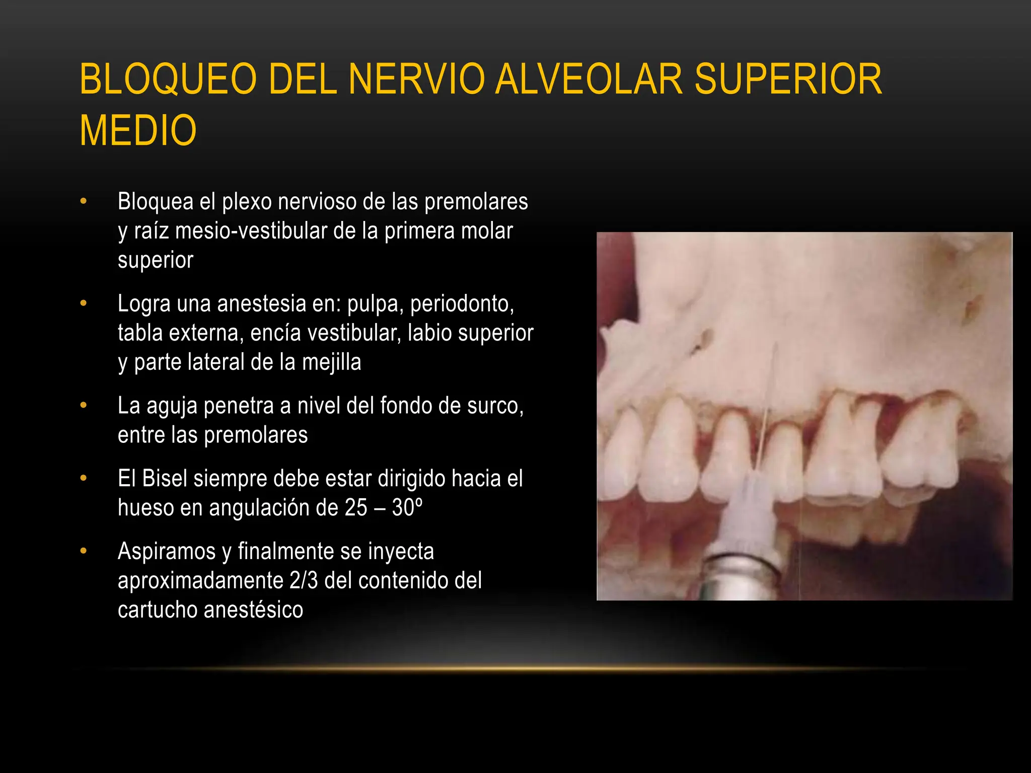 Tecnicas de anestesia en maxilar superior | PPT