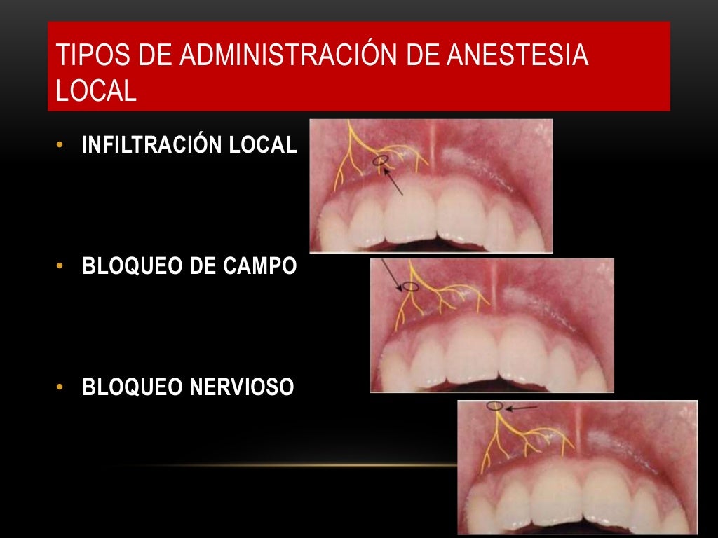 Técnicas de anestesia local