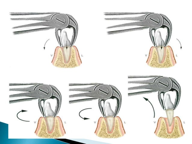 Técnicas de exodoncia en maxilar y mandíbula | PPTX