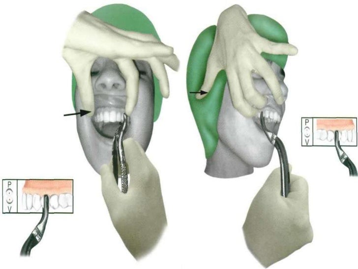 Técnicas de exodoncia en maxilar y mandíbula