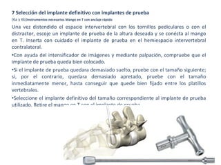 Técnicas de fusión intersomática | PPT
