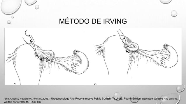 TÉCNICAS QUIRÚRGICAS ALTERNATIVAS AL POMEROY.pptx