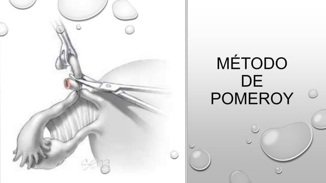 TÉCNICAS QUIRÚRGICAS ALTERNATIVAS AL POMEROY.pptx