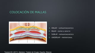 Técnicas quirúrgicas de reparación de pared abdominal.pptx