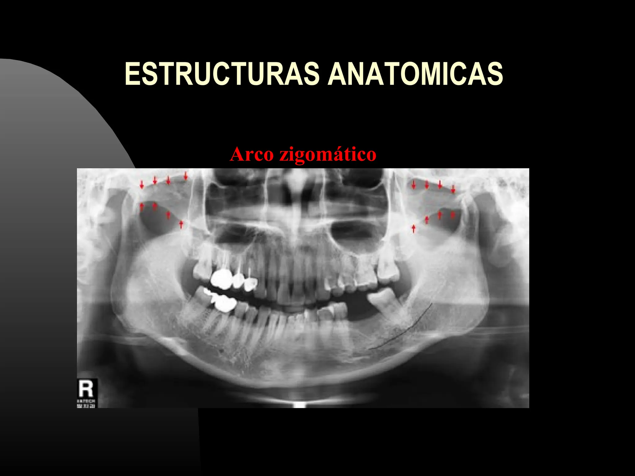 técnicas radiografías panoramicas aplicadas en odontologia | PDF | Bone ...