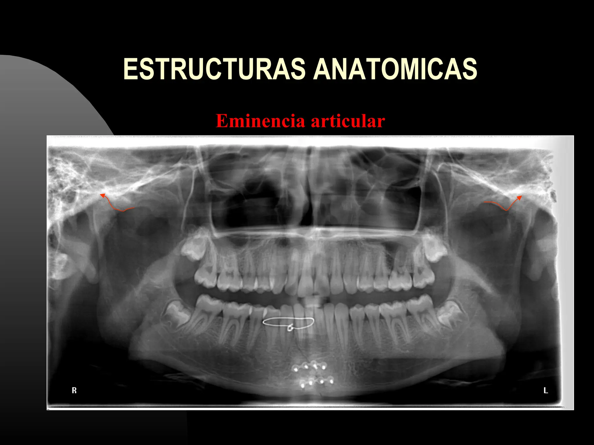 técnicas radiografías panoramicas aplicadas en odontologia | PDF | Bone ...