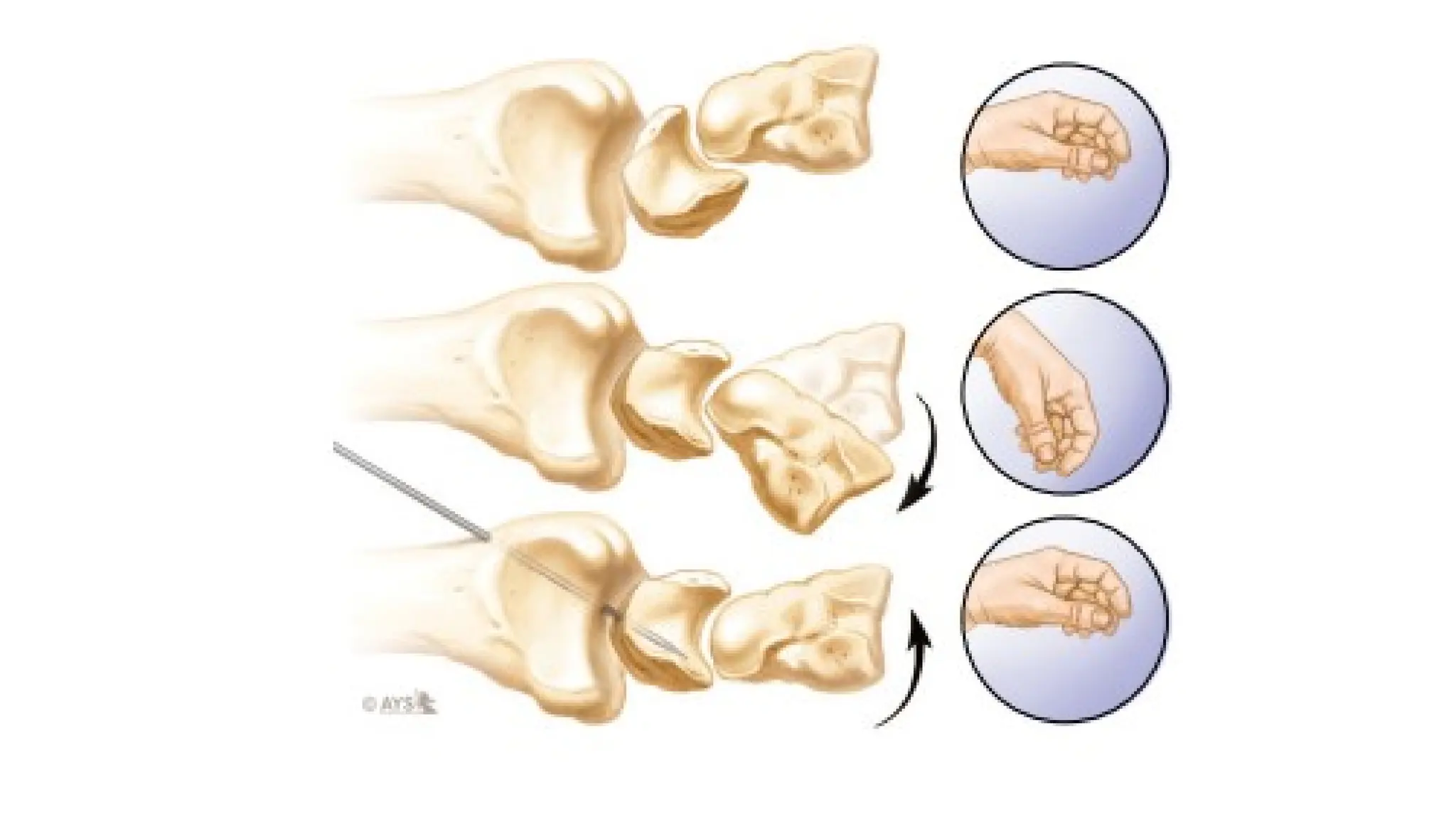 tddd.pptx wrist arthodesis final ppt 33 years | PPT