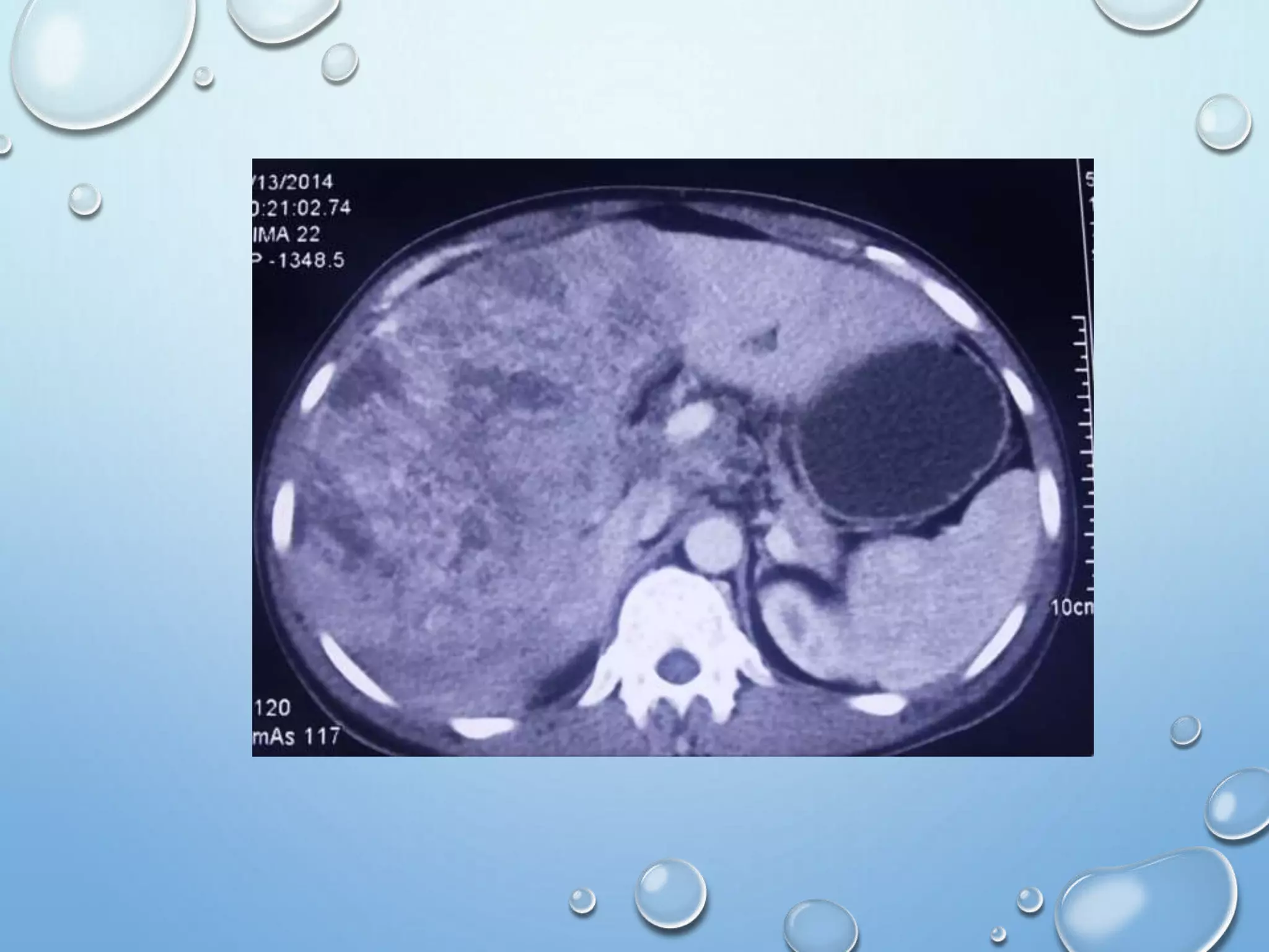 Liver resection indications & methods | PPTX