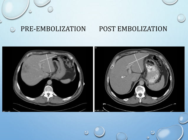 Liver resection indications & methods | PPTX | Blood Disorders ...