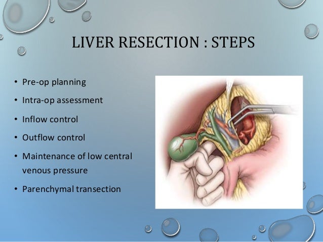 Liver resection indications & methods