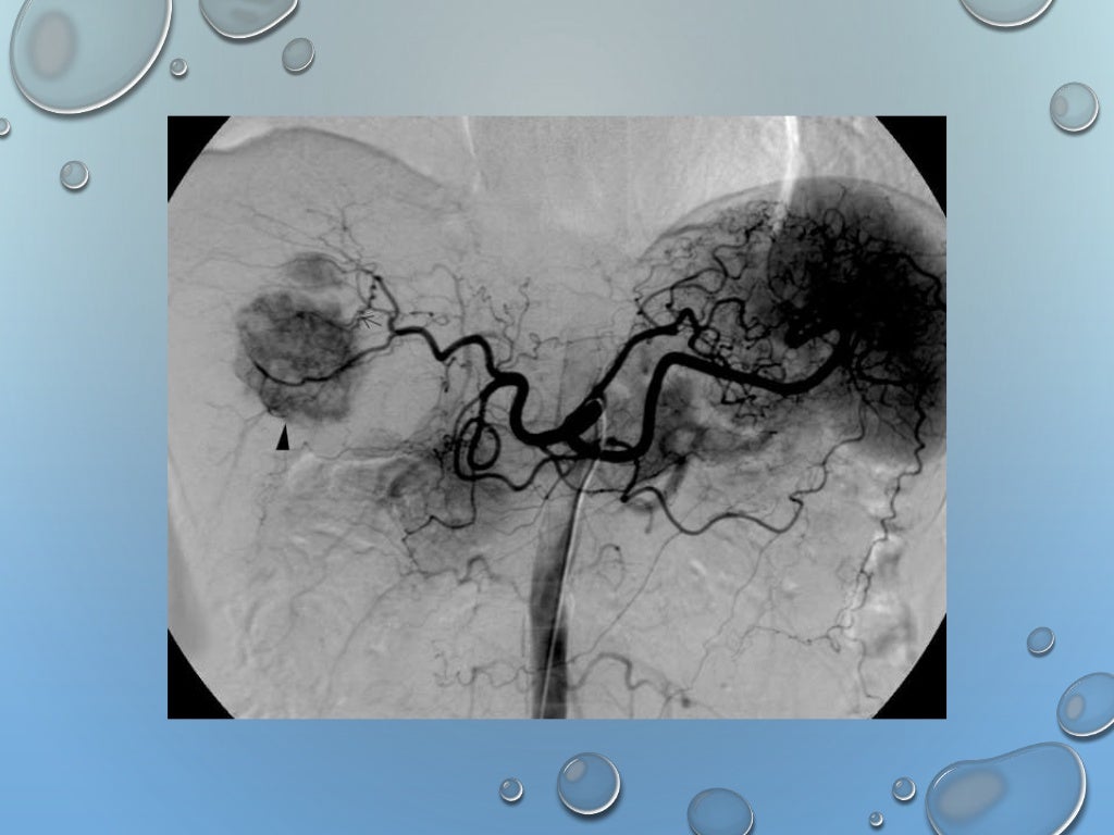 Liver resection indications & methods