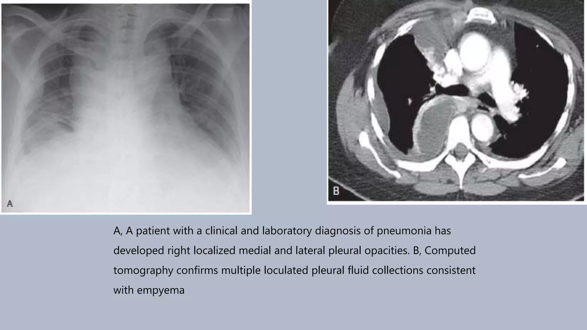 Chest radiology ( pattern and differential diagnosis ) Text book ...